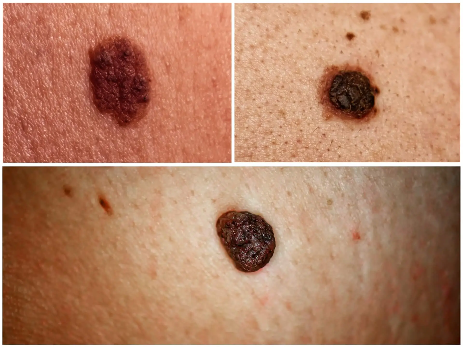Skin Cancer – Malaysian Skin Foundation